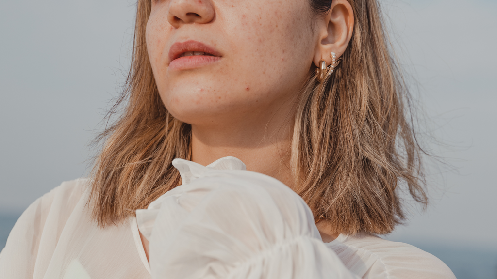 The Great Balancing Act In Adult Acne – LifeLAB Med