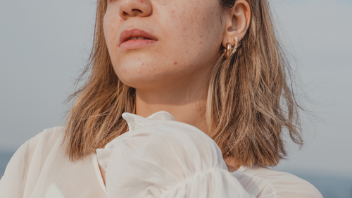 The Great Balancing Act In Adult Acne – LifeLAB Med